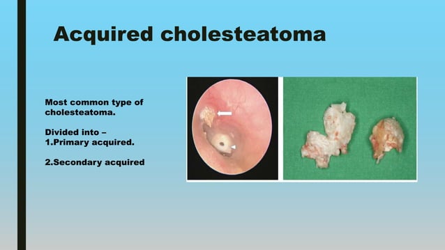 Cholesteatoma | PPTX