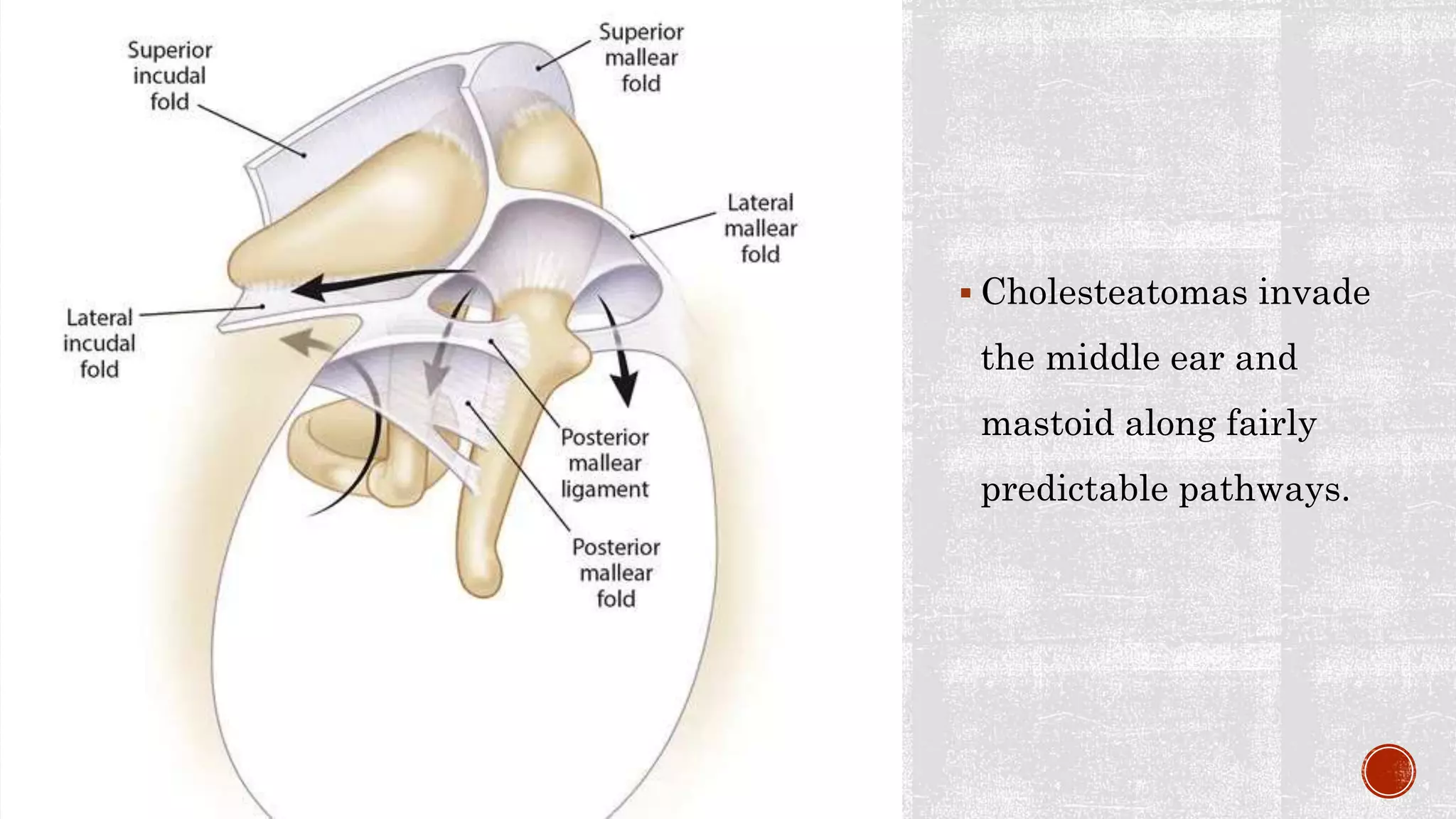 Cholesteatoma etiology, theories, clinical features and management | PPTX