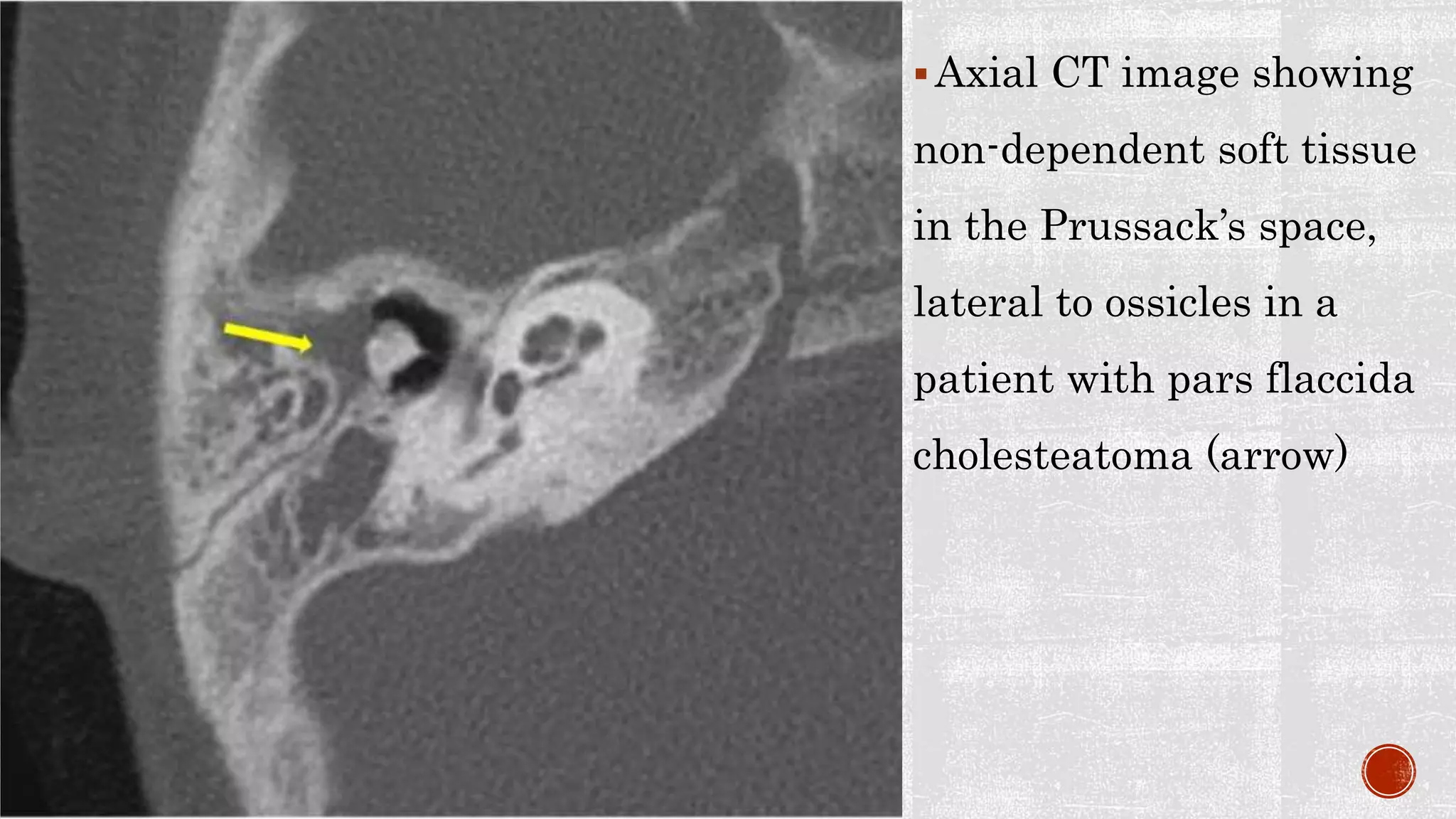 Cholesteatoma etiology, theories, clinical features and management | PPTX