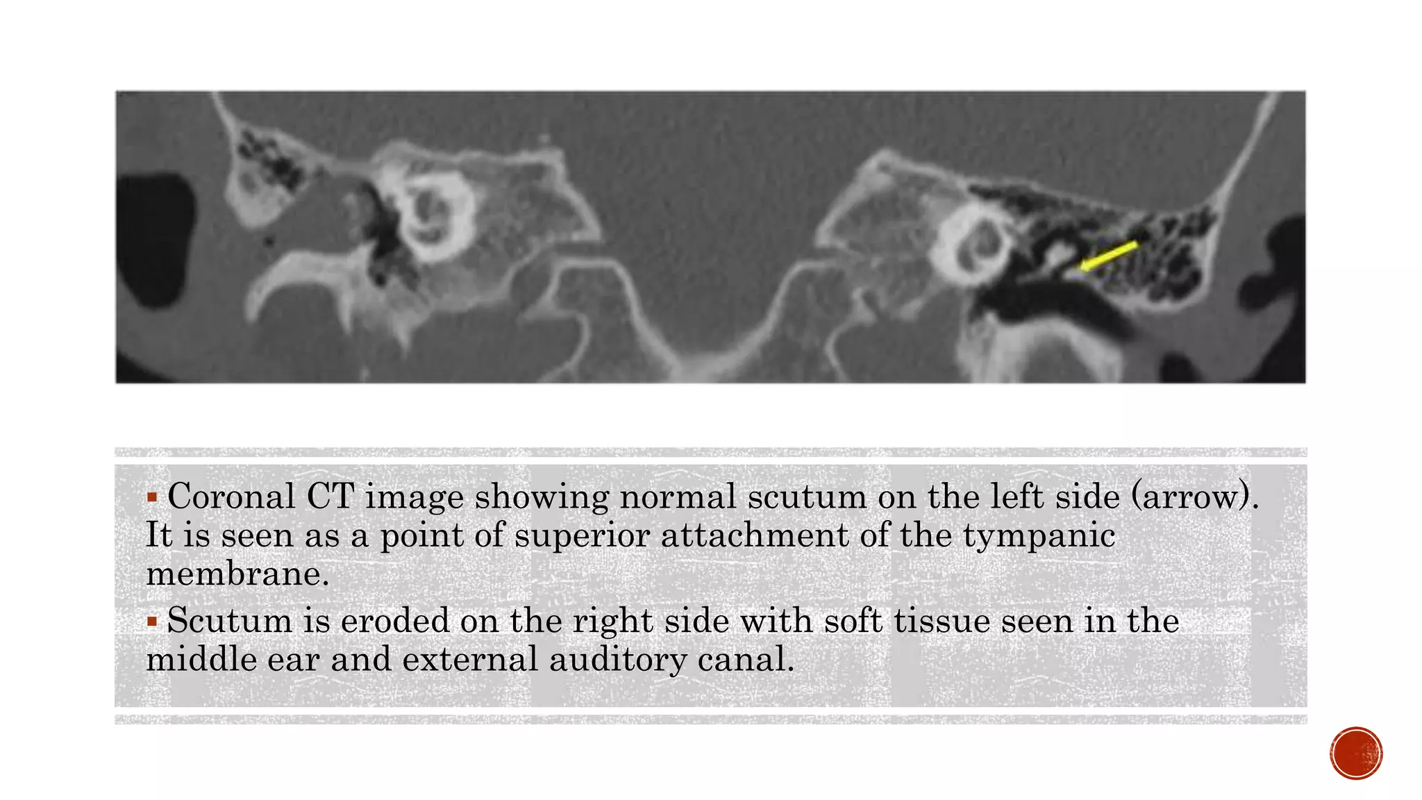 Cholesteatoma etiology, theories, clinical features and management | PPTX