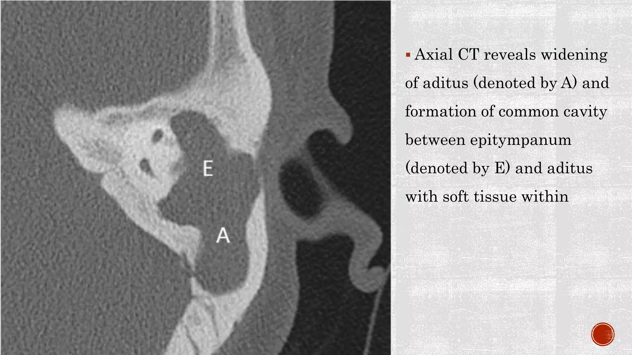Cholesteatoma etiology, theories, clinical features and management | PPTX