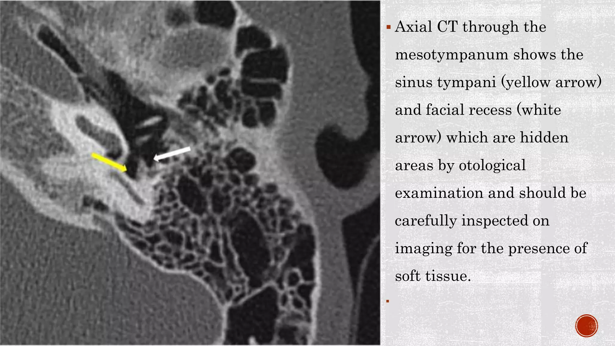 Cholesteatoma etiology, theories, clinical features and management | PPTX