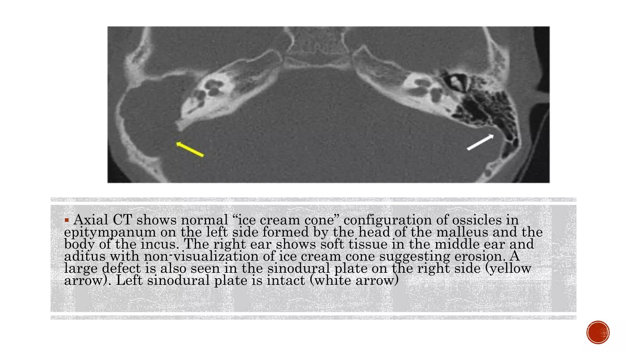 Cholesteatoma etiology, theories, clinical features and management | PPTX