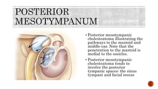 Cholesteatoma etiology, theories, clinical features and management | PPTX