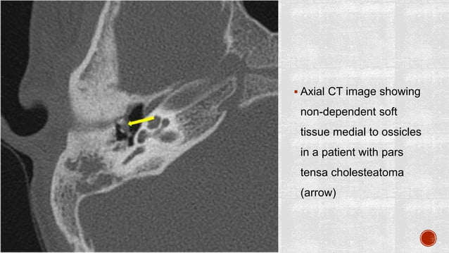 Cholesteatoma etiology, theories, clinical features and management ...