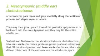 Cholesteatoma: General Considerations by dr rajendra singh lakhawat | PPTX
