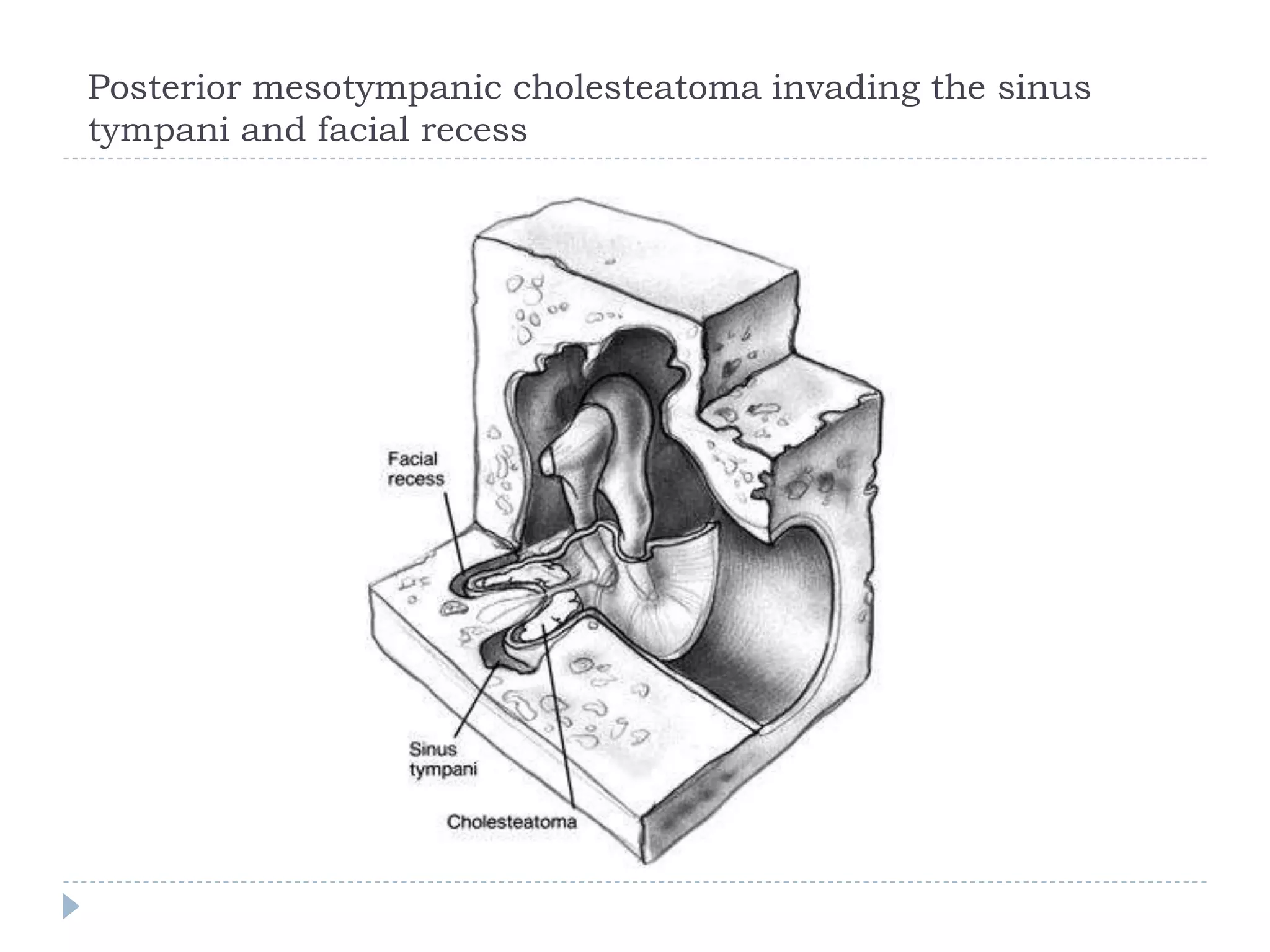 Cholesteatoma CME | PPTX