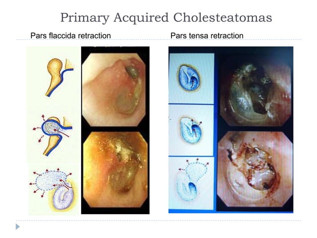Cholesteatoma CME | PPTX | Ear, Nose and Throat Conditions | Diseases ...