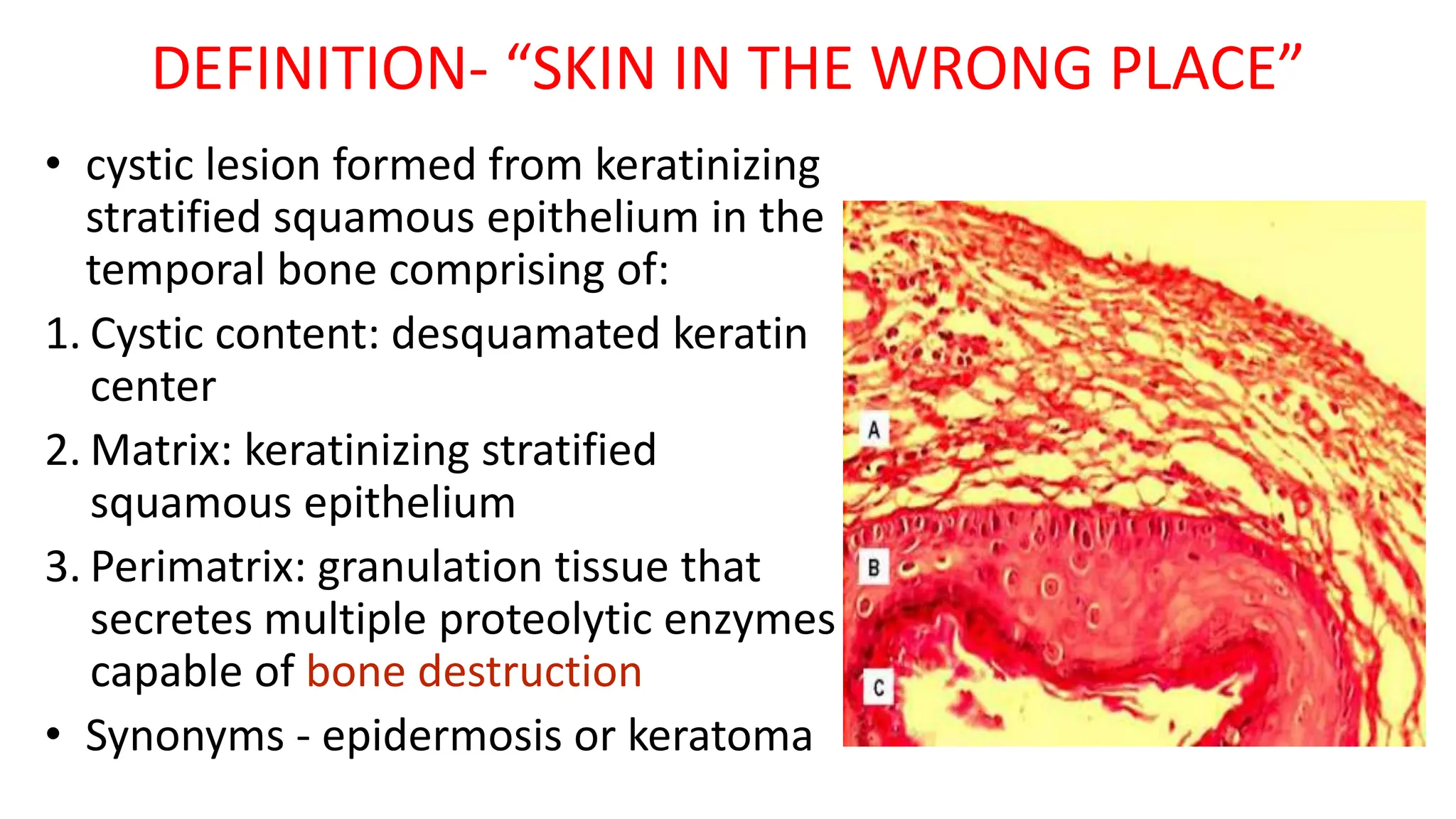 CHOLESTEATOMA new.pptx