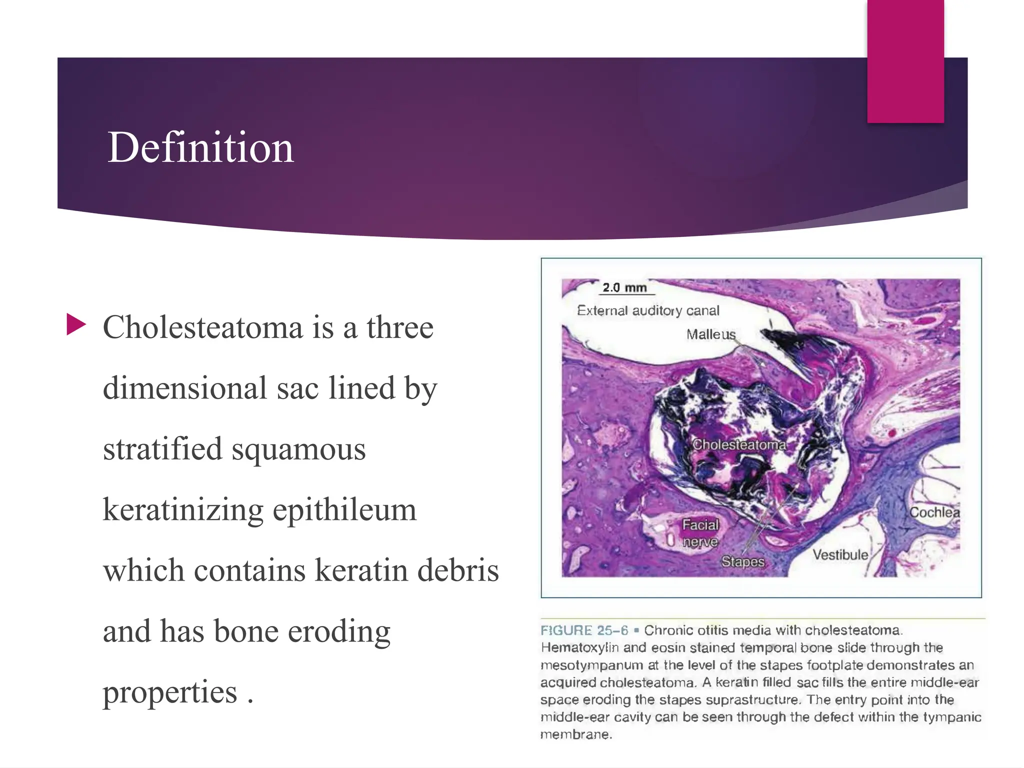 This presentation is about Cholesteatoma | PPTX