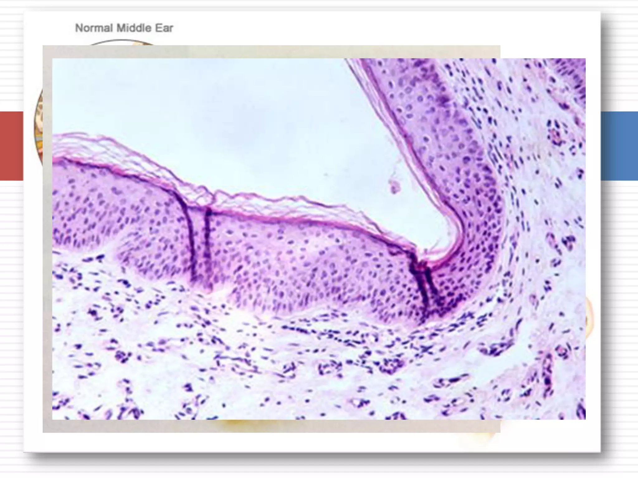 Cholesteatoma and chronic suppurative otitis media | PPTX