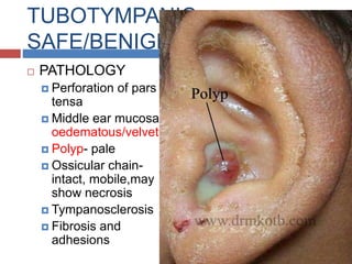Cholesteatoma and chronic suppurative otitis media | PPTX