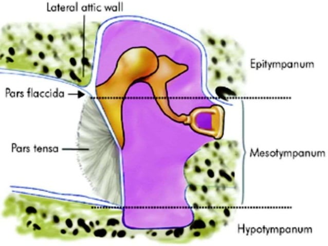 Cholesteatoma and chronic suppurative otitis media | PPTX