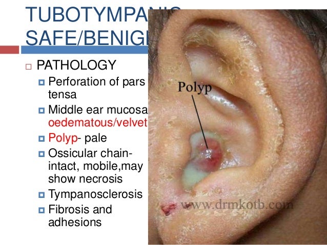 Cholesteatoma and chronic suppurative otitis media
