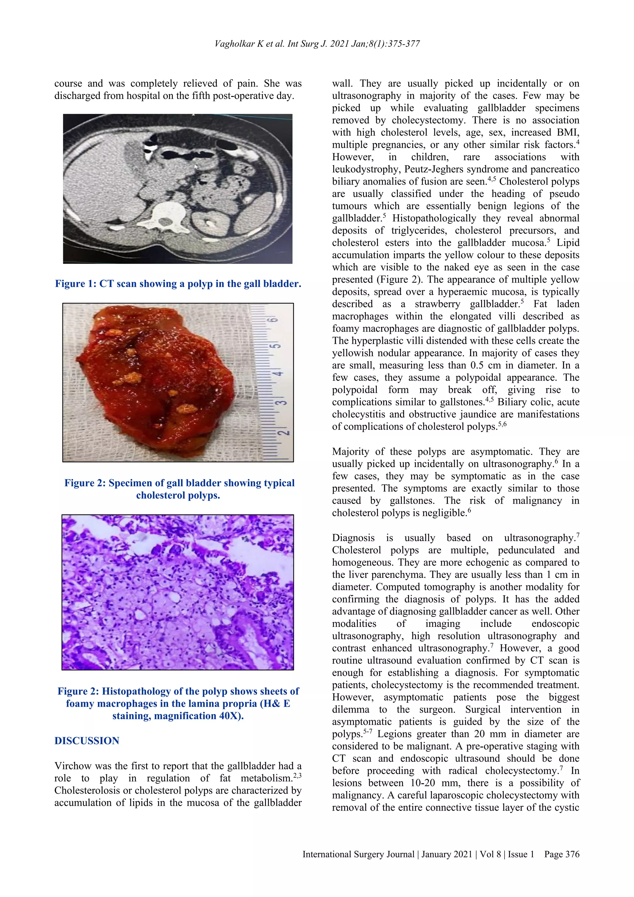 Cholesterolosis of the gall bladder: a surgical dilemma | PDF