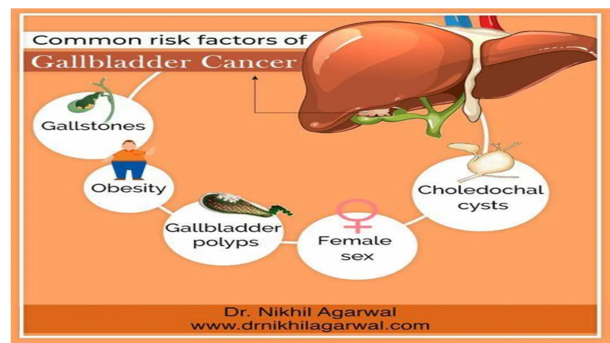 cholilithiasis, cholecystitis,gall bladdder .pdf