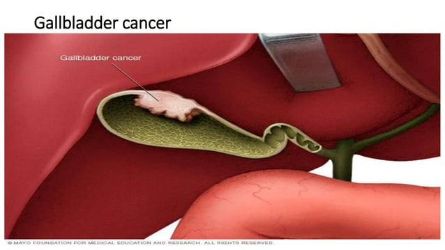 cholilithiasis, cholecystitis,gall bladdder .pdf