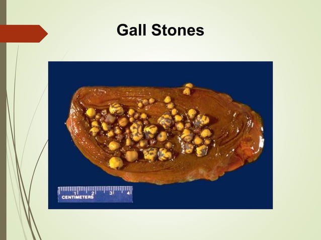 cholycystitis - inflammation of gall bladder | PPTX
