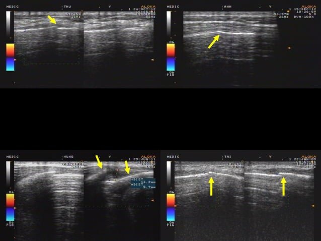 Chondral and Bony Rib Fracture in Relevation by Ultrasound | PPT ...