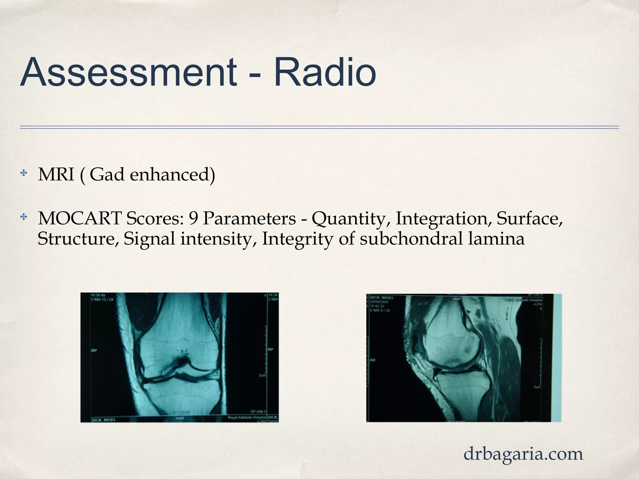 Chondral Injuries - Current Concepts in Management & Cartilage ...