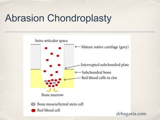 Chondral Injuries - Current Concepts in Management & Cartilage ...