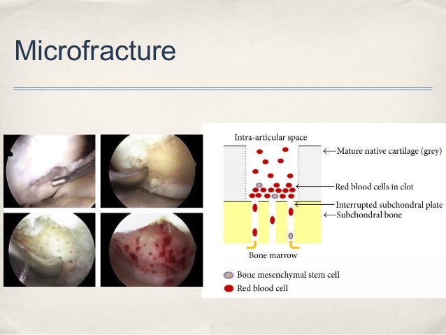 Chondral Injuries - Current Concepts in Management & Cartilage Regene…