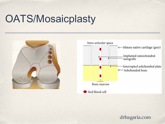 Chondral Injuries - Current Concepts in Management & Cartilage Regene…