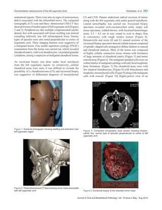 Chondroblastic osteosarcoma of the left zygomatic bone rare case report ...