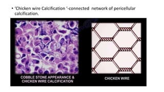 Chondroblastoma Chicken Wire