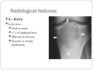 Chondroblastoma Chicken Wire
