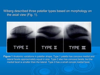 Chondromalacia patella | PPT