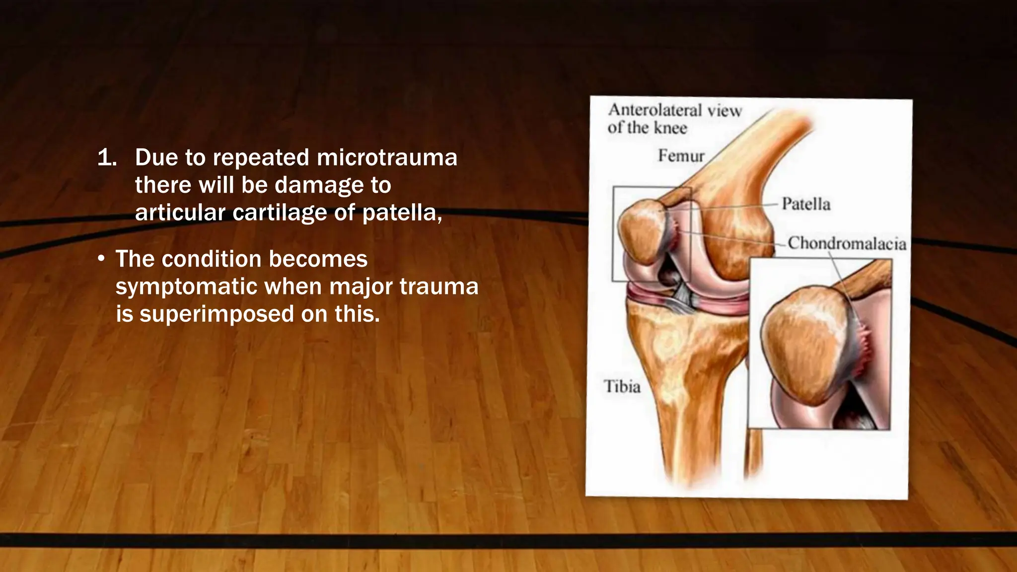 CHONDROMALACIA PATELLA-DESKTOP-G8N93PS.pptx