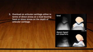 CHONDROMALACIA PATELLA-DESKTOP-G8N93PS.pptx