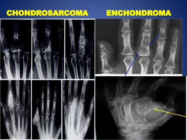 Chondrosarcoma