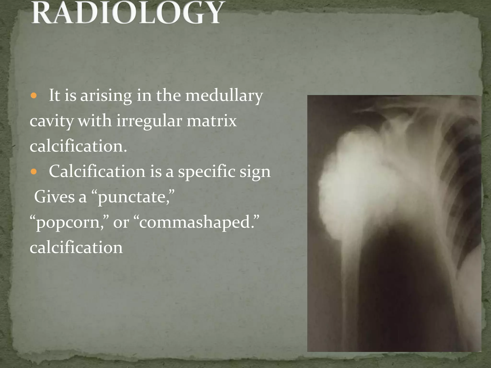 Chondrosarcoma | PPTX | Bone and Joint Conditions | Diseases and Conditions