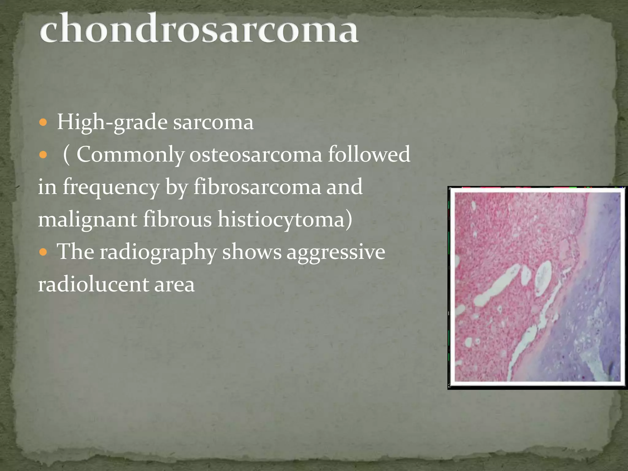 Chondrosarcoma | PPTX