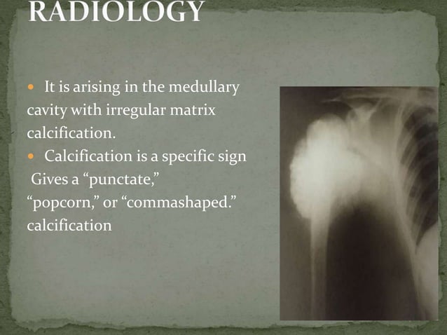 Chondrosarcoma | PPTX | Bone and Joint Conditions | Diseases and Conditions