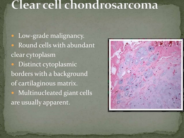 Chondrosarcoma | PPTX | Bone and Joint Conditions | Diseases and Conditions