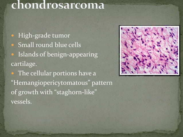 Chondrosarcoma | PPT
