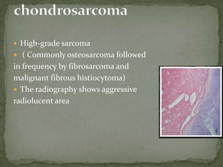 Chondrosarcoma | PPTX | Bone and Joint Conditions | Diseases and Conditions