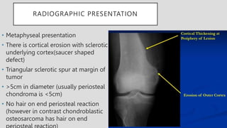 CHONDROSARCOMA an overview, classification and treatment. | PPTX