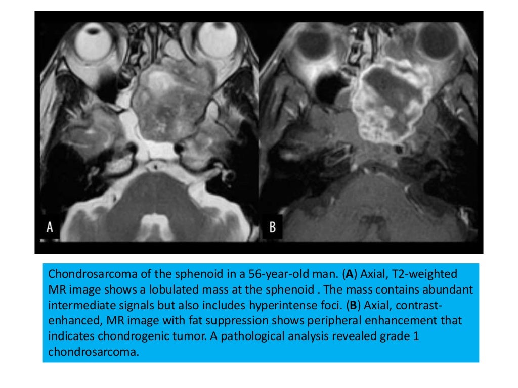 Chondrosarcoma of skull base,Radiology point of view