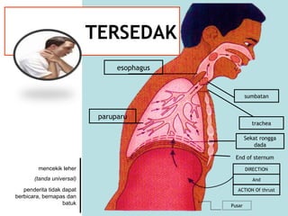 Tersedak | PPT