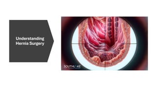 Choosing Top Hernia Surgeon In Texas.pdf