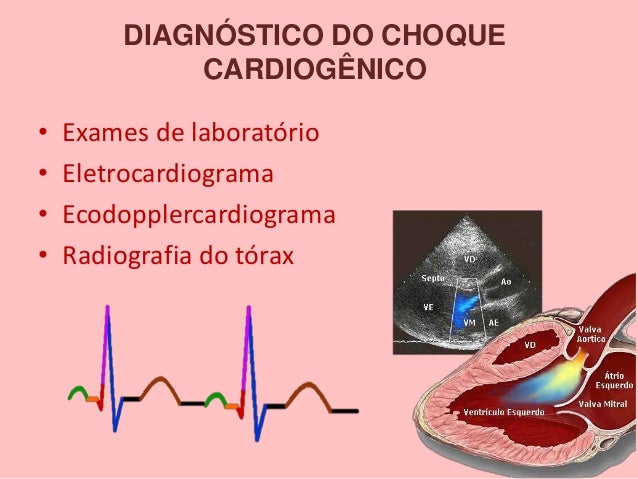 Choque cardiogênico