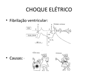 Choque eletrico | PPT