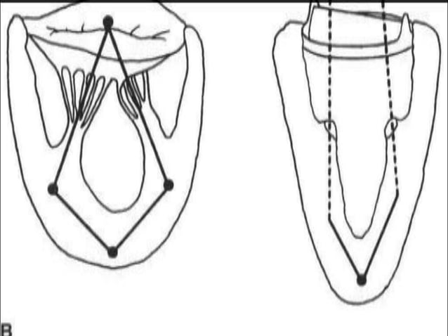 Chordal preservation in mitral valve replacement | PPTX