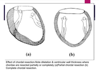 Chordal preservation in mitral valve replacement | PPTX