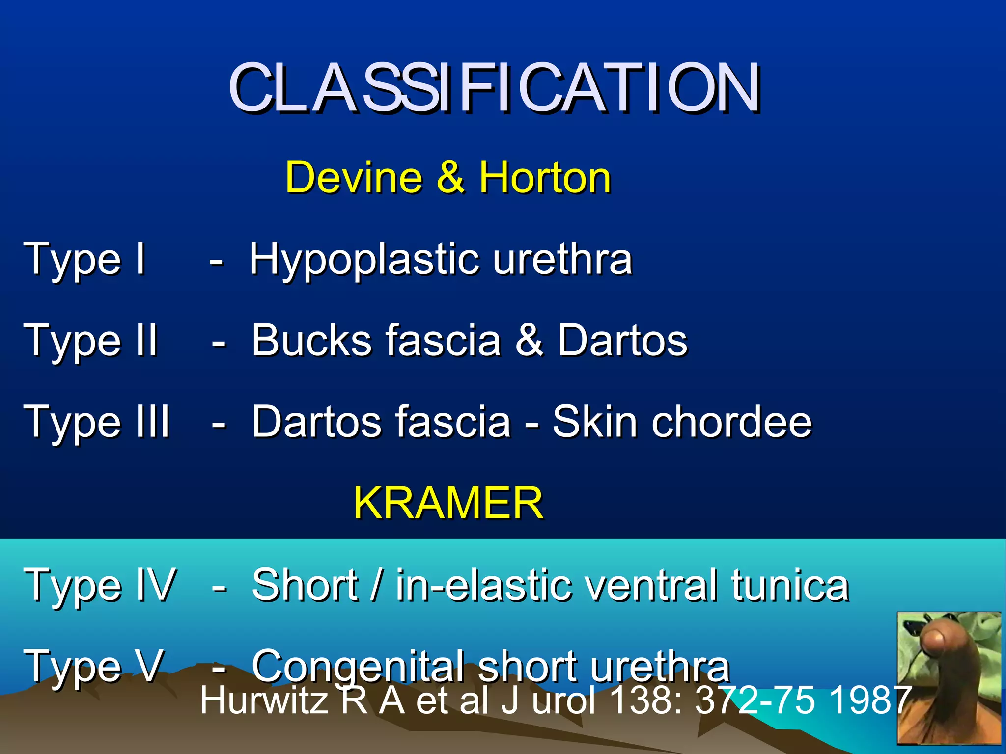 A rational approach in Chordee without hypospadias | PPT