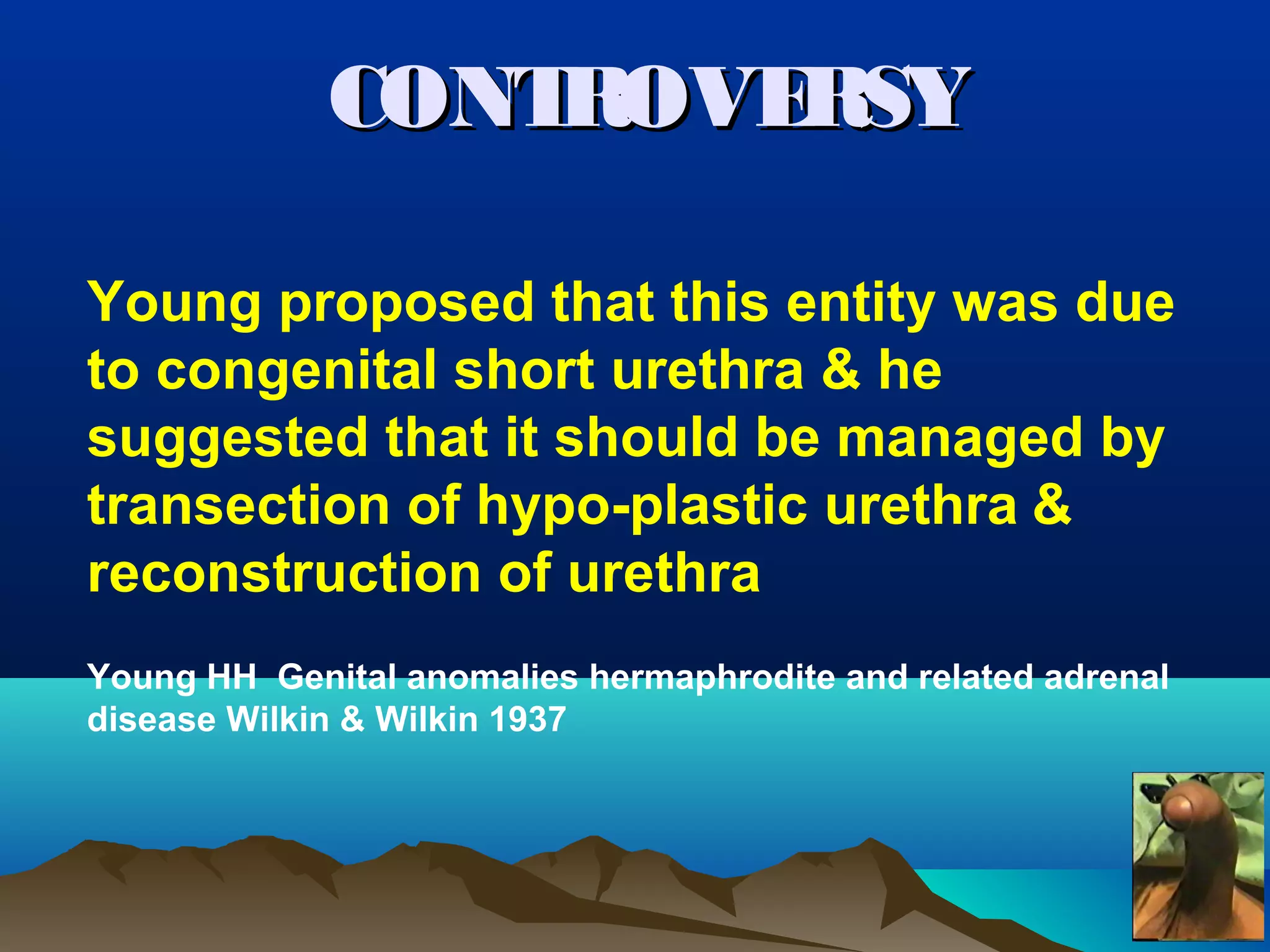 A rational approach in Chordee without hypospadias | PPT